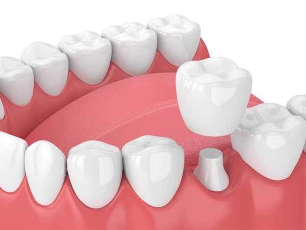 Tooth Crown Fittings New Forest | Oral Cosmetic Services Southampton