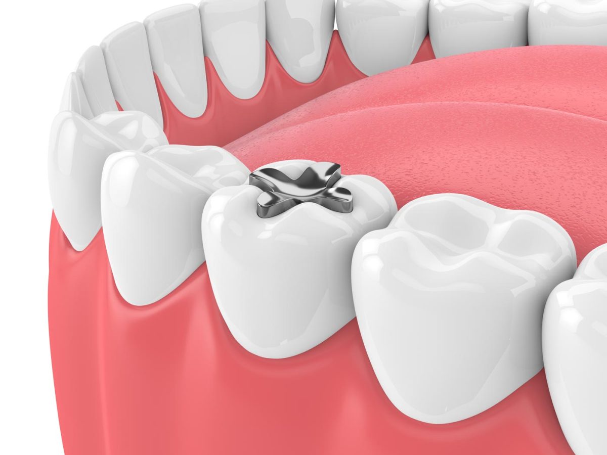 Dental Fillings New Forest | Tooth Filling Services & Prices