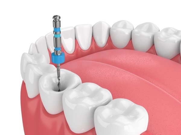 Root Canal Surgery New Forest | Dental Treatment Services Southampton