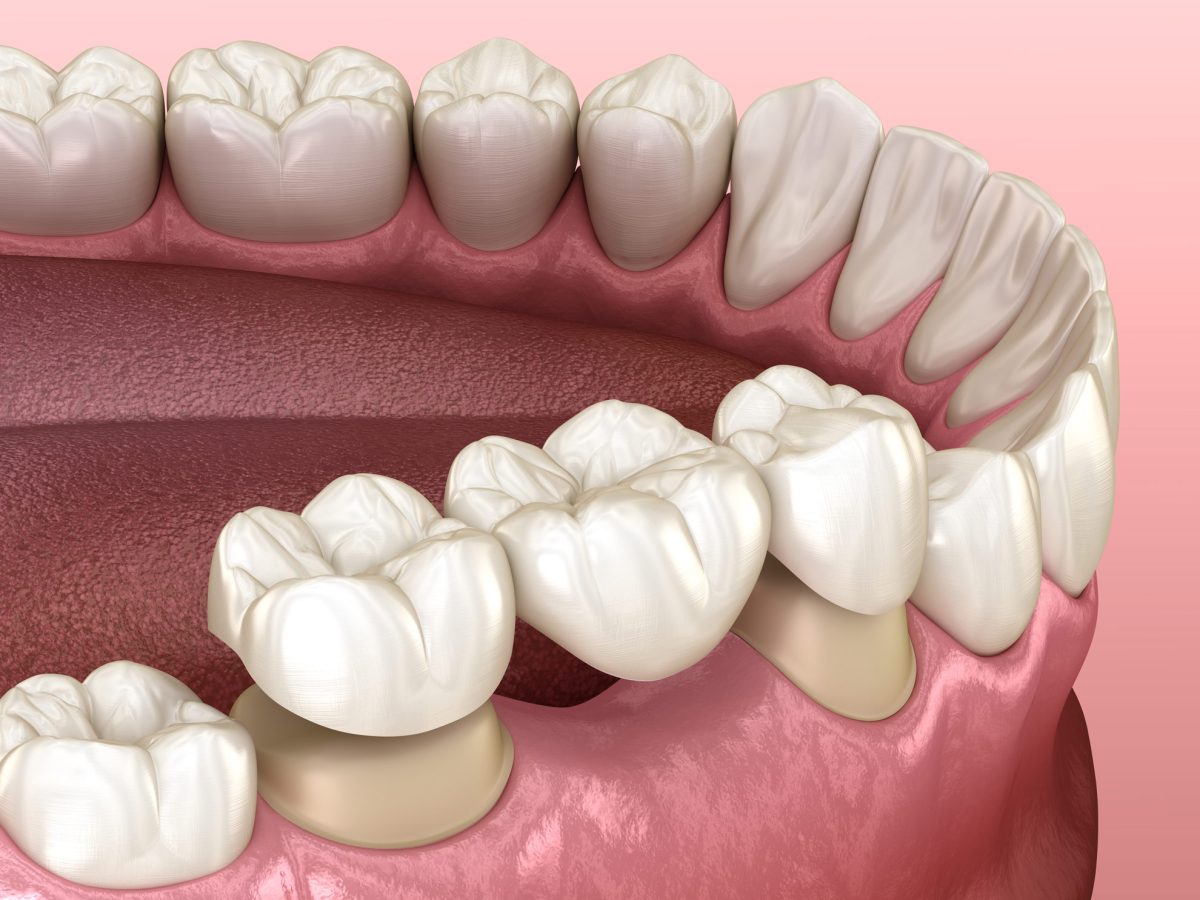 Dental Bridge Services New Forest | Teeth Fittings & Prices